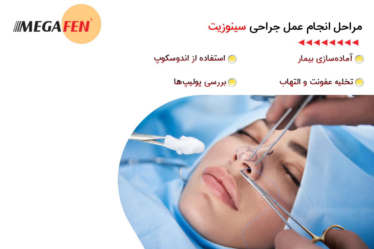 عمل سینوزیت چگونه است؟ تاثیر عمل سینوس بینی بر پولیپ و انحراف بینی - مگافن